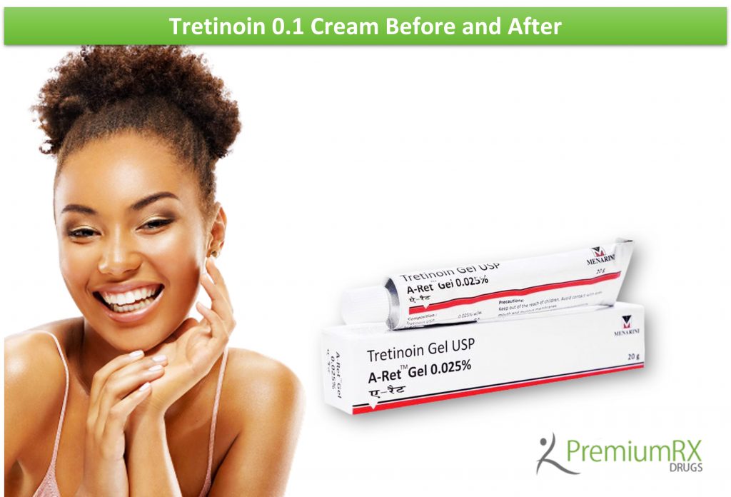 Tretinoin Cream Before And After